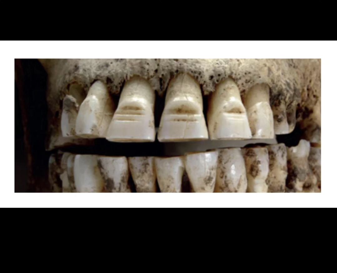 Viking Dental Work - Weird History Stories